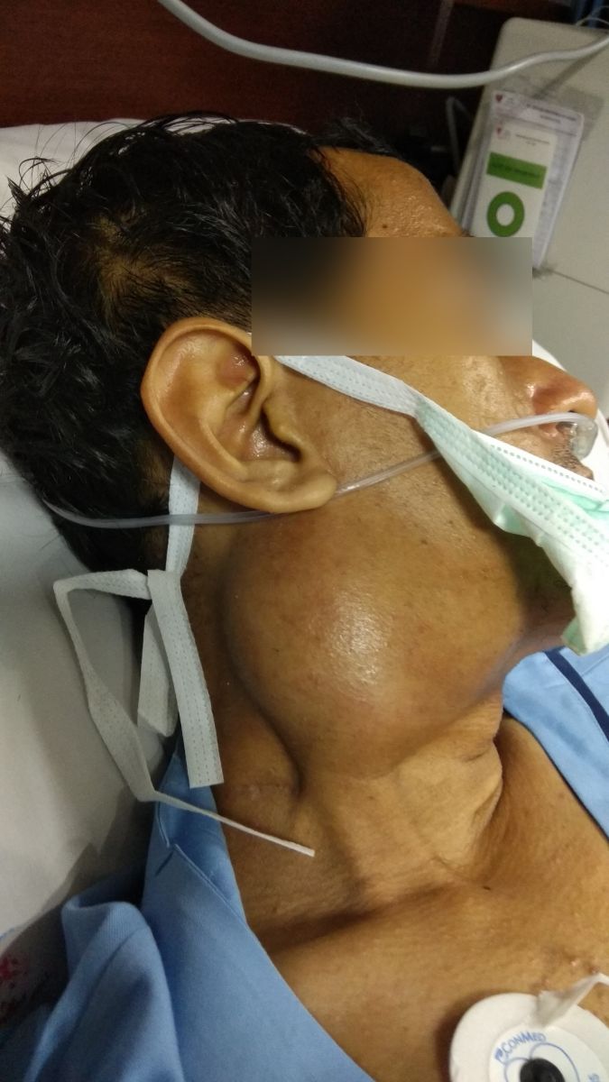 Sacrifation Of Right Carotid Artery With Giant Aneurysm A Safe Bet